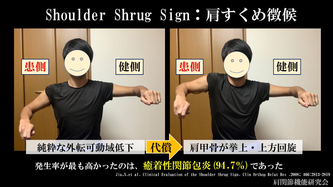 みんな知ってる？肩すくめ徴候Shoulder shrug sign | 肩関節機能研究会(肩研)