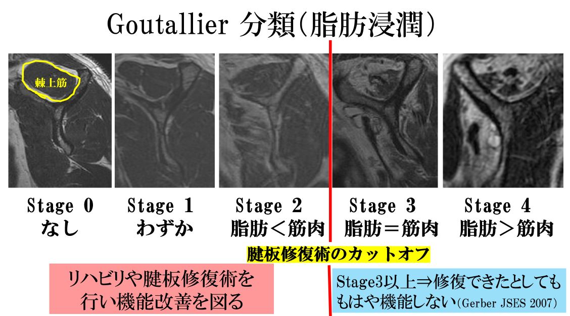 腱板断裂のキーポイント 腱板修復術の適応基準とGoutallier分類 | 肩関節機能研究会(肩研)