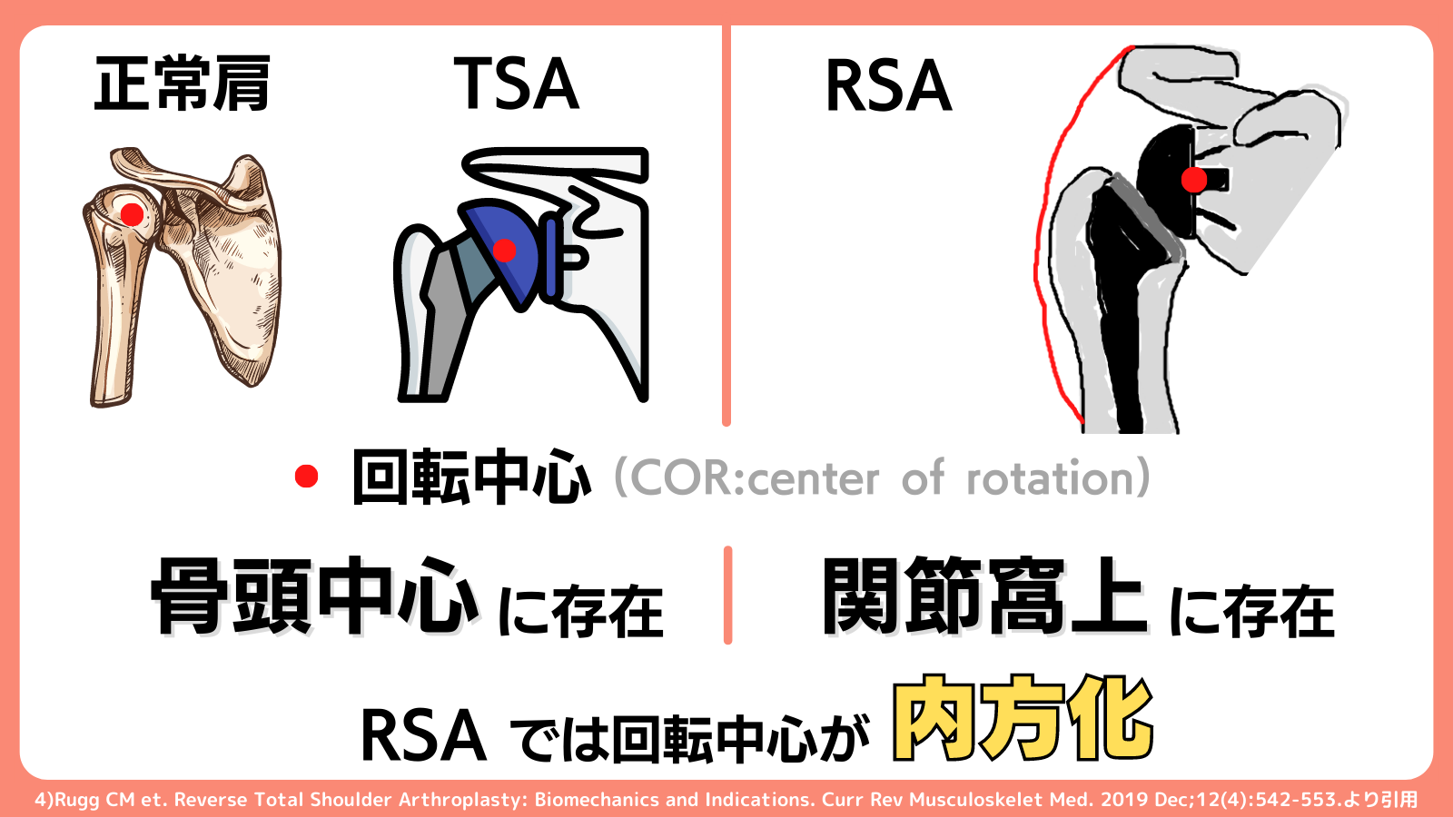 RSAの概要 | 肩関節機能研究会(肩研)